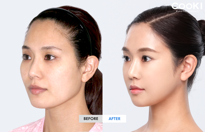 Cheekbone Reduction